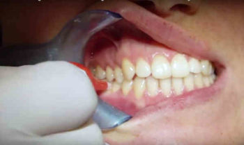 Zahnfleischentzündung - Die heimliche Gefahr, gut versteckt und böse